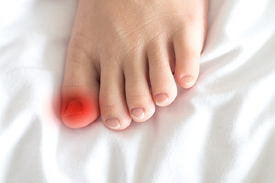 Understanding and Treating Ingrown Toenails